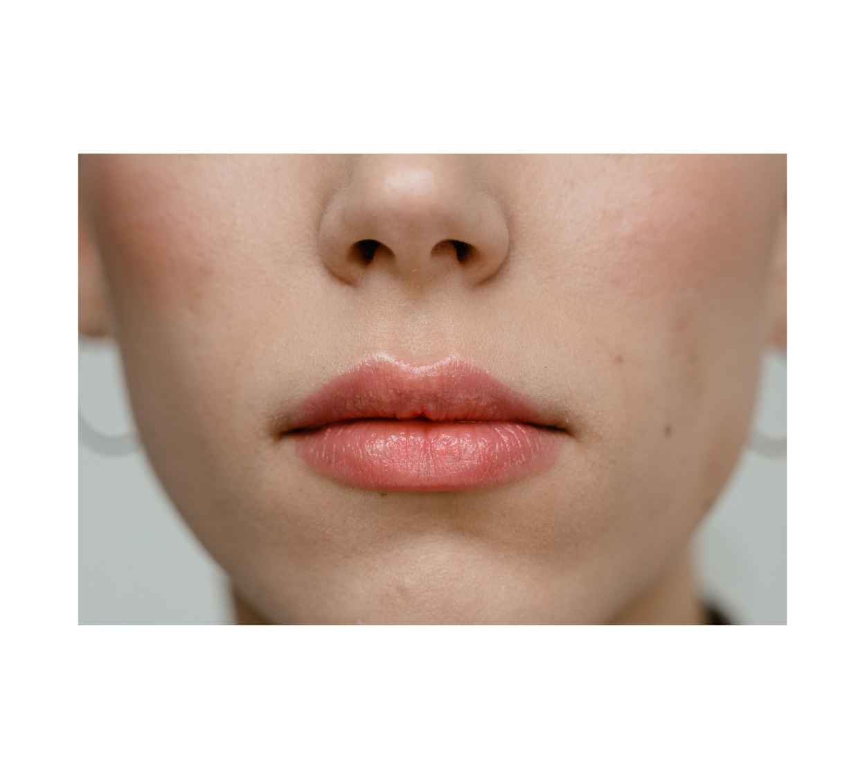 Everything You Need to Know About Upper Lip Shortening Botox for ...