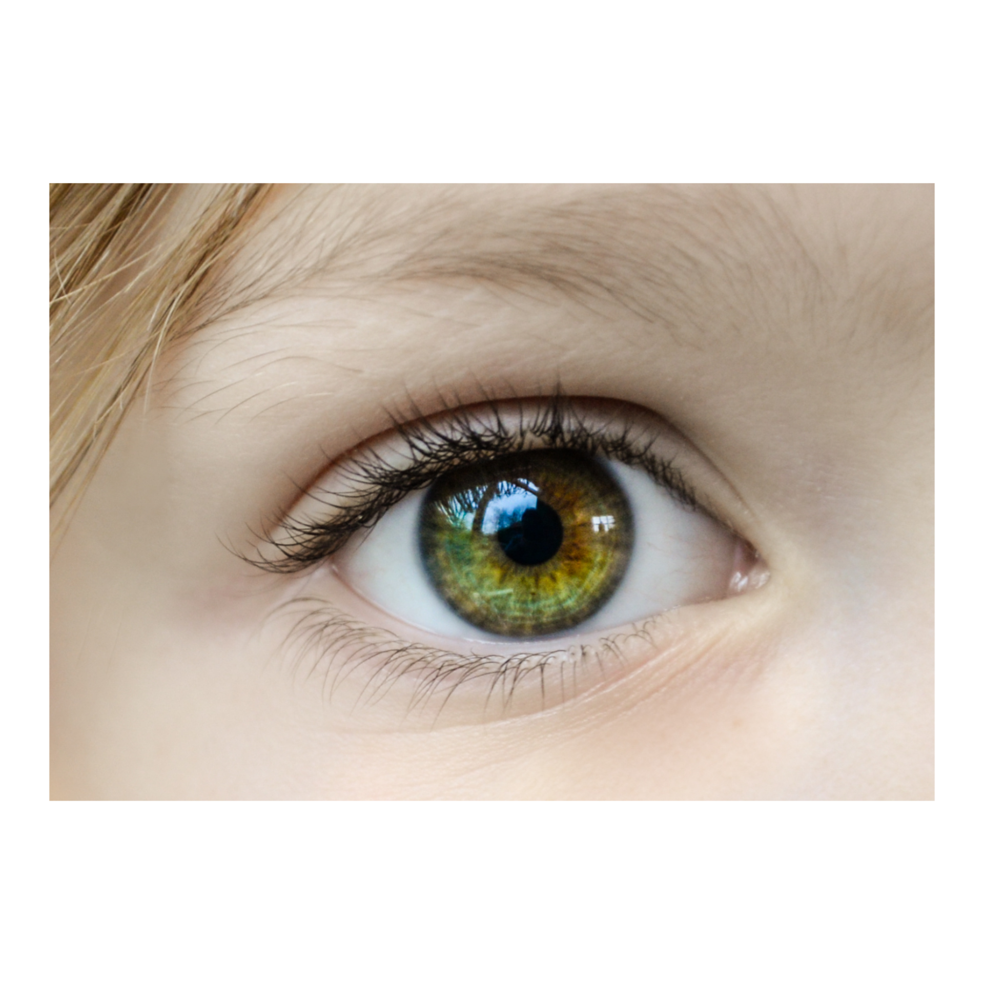 Why Botox for the Inner Corner of the Eyes Changes the Impression of ...